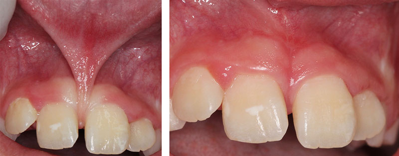 Frenectomy Wyndham Periodontist