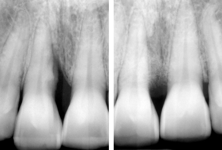 Access Flap Surgery - Wyndham Periodontist