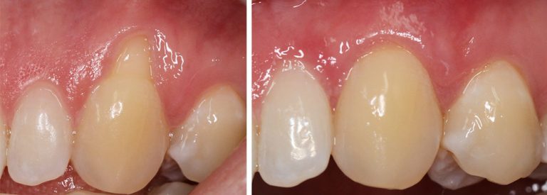 Plastic and reconstructive peridontal surgery - Wyndham Periodontist